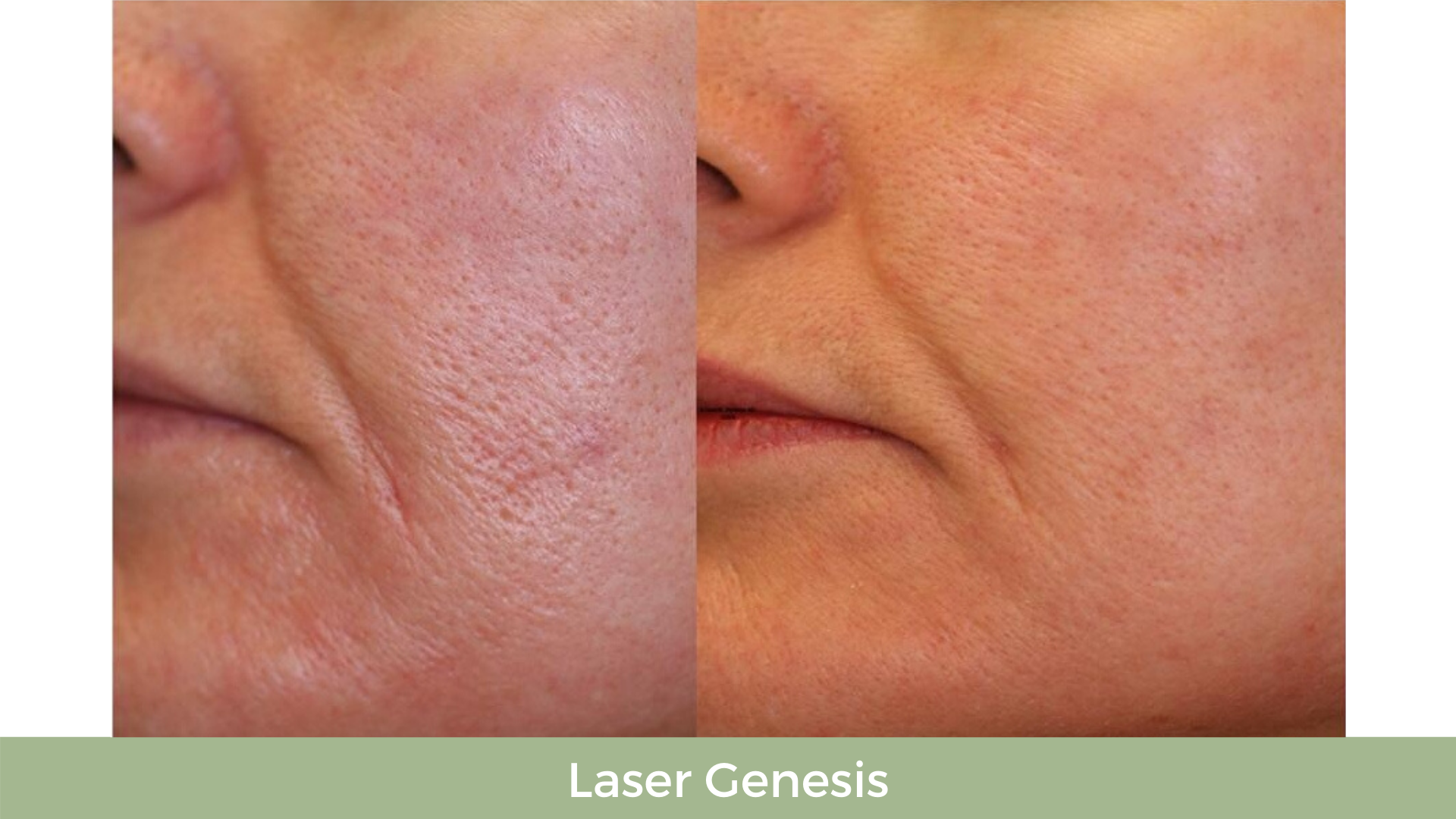 Skin Rejuvenation - staging.lasersense.co.za